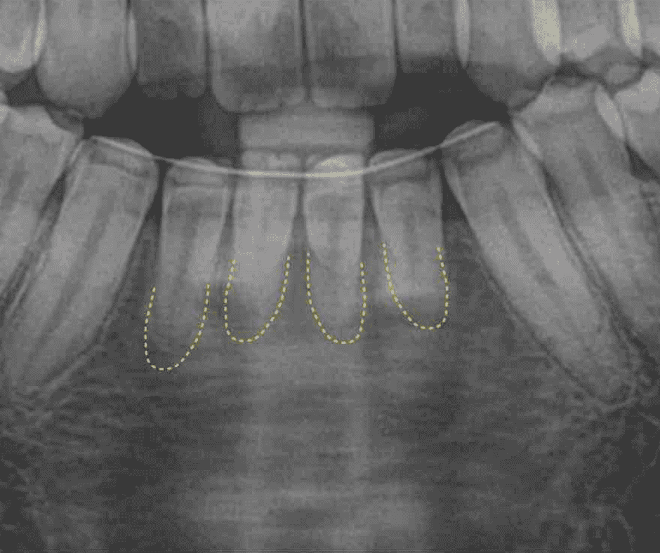 Reabsorción radicular en adultos: síntomas, causas y tratamiento