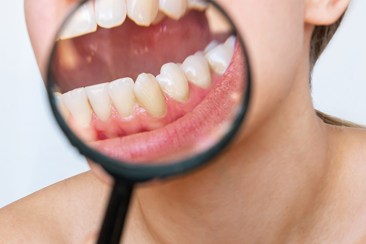 ¿Cómo eliminar el sarro de los dientes? - Dental Arrasate