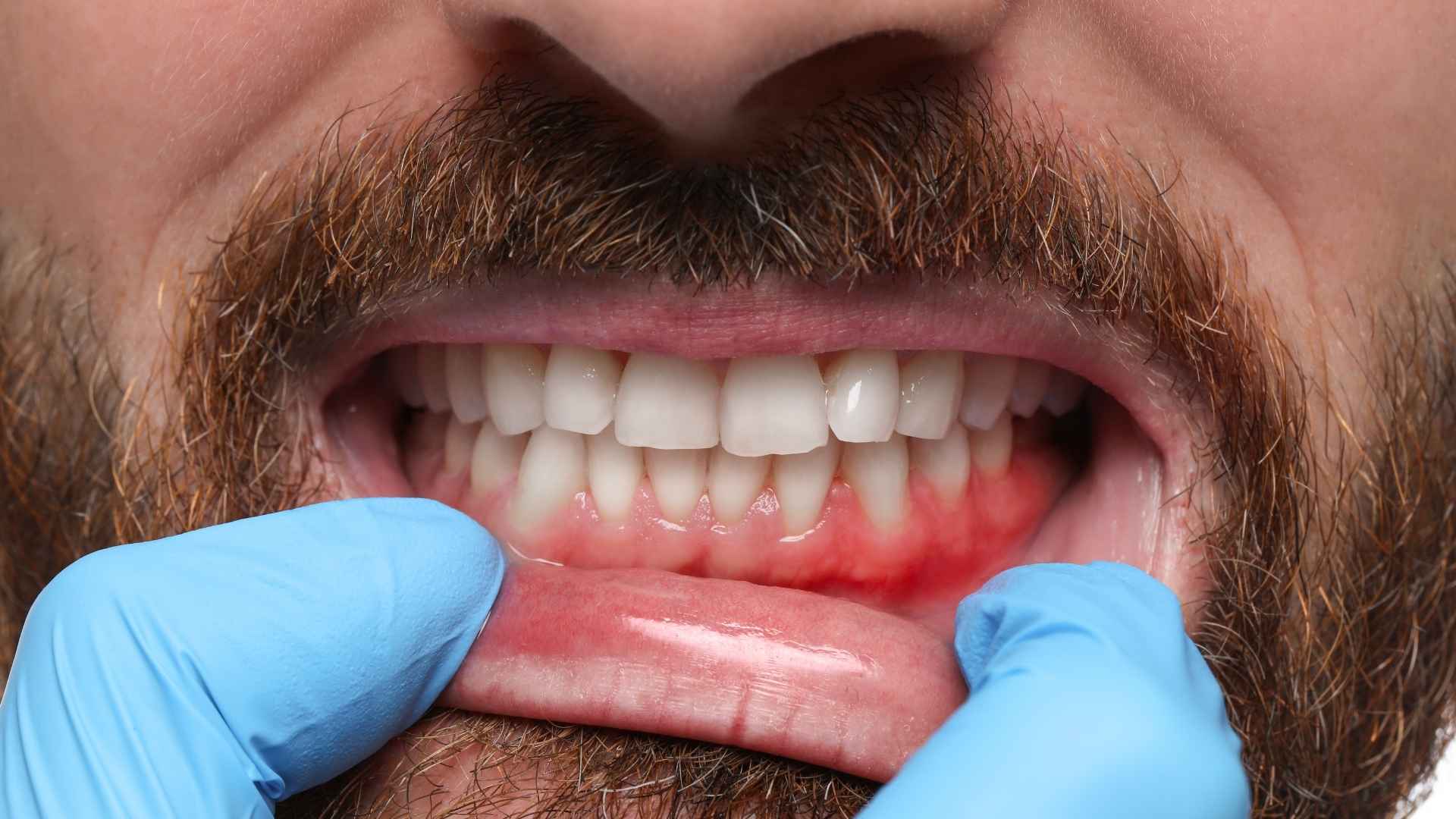 ¿La gingivitis es contagiosa? Causas, prevención y tratamiento