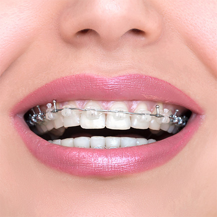 Brackets transparentes, Invisalign, ortodoncia para niños en Arrasate